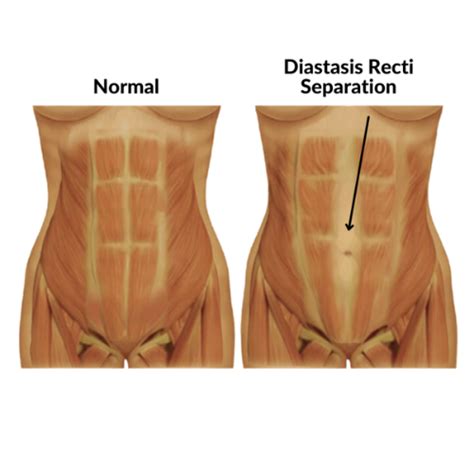 How To Check For Diastasis Recti What It Looks Like And How To Fix It