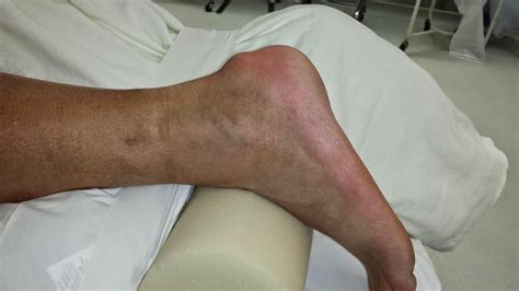 Dr K Lam Straight Talk Lump On Back Of The Heel Haglunds Deformity Achilles Tendonitis