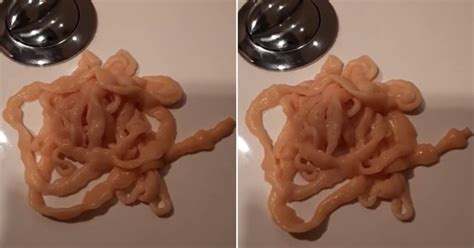 Man Pulls Moving Tapeworm Out Of His Own Backside Metro News