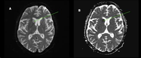 A Diffusion Weighted Magnetic Resonance Imaging Axial Section Of The Download Scientific