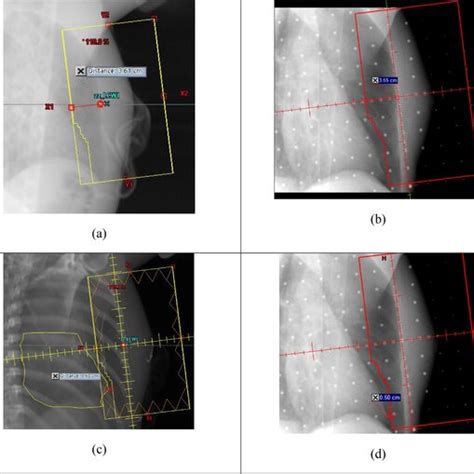 Example Volumetric Modulated Arc Therapy Vmat Patient Sternum To Iso