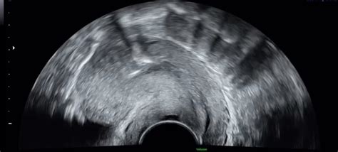 Ecole E3f On Linkedin Hyfosy Echographie Fertiliscan Fertilité E3f