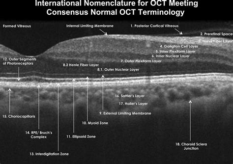 Proposed Lexicon For Anatomic Landmarks In Normal Posterior Segment