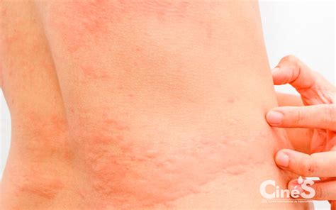 🥇 Cómo Prevenir Y Tratar La Alergia A Los ácaros En La Piel Trucos De