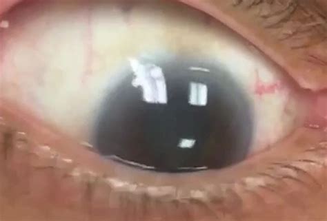 Rodney Omron On Twitter Patient Had Hyperreflexia Fever Ams Pupil Is Dilated But Reactive