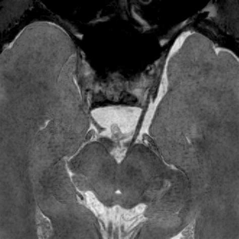 Interpeduncular Fossa Mri