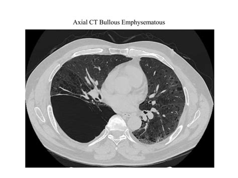 Differential Diagnosis Of Pulmonary Cyst 1 Bullous Emphysema 2 Cystic Bronchiectasis 3