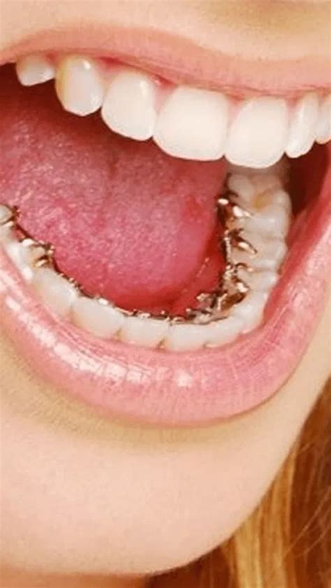 Braces Sensitive Teeth Healthy Teeth Teeth Whitening