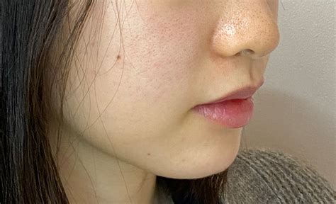 ヒアルロン酸アゴ Original Beauty Clinic GINZA