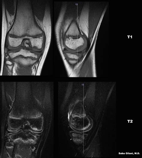 Roentgen Ray Reader Osteochondritis Dissecans Revisited
