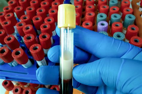 Remnant Cholesterol What Is It And How Is It Calculated