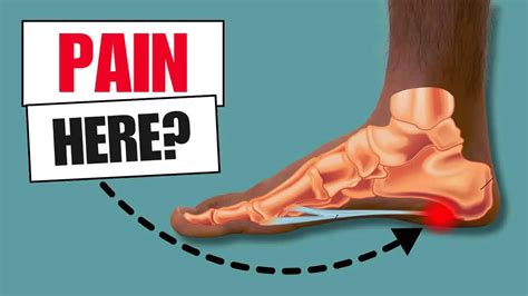 How To Fix Plantar Fasciitis Scientifically Proven Pain Physio