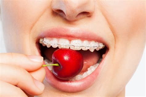 Sexo oral con brackets qué precauciones tomar Nexofin