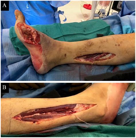 Necrotizing Fasciitis Of Leg What Its Like To Have And Survive