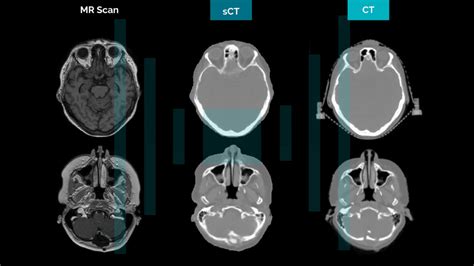 Deep Learning To Generate Synthetic Ct Images From Mr For Radiotherapy Treatment Planning