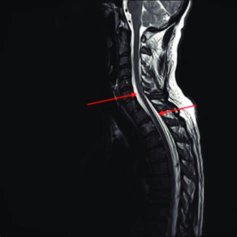 Sagittal T2 Weighted Magnetic Resonance Spine Demonstrating Anterior