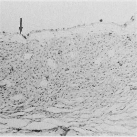 Case 2 Left Eye Left Photomicrograph Showing Diffuse Choroidal