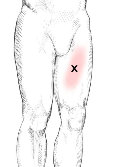 Sartorius Trigger Points Sartorius Trigger Points