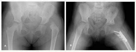 Dega Osteotomy For The Treatment Of Developmental Dysplasia Of The Hip
