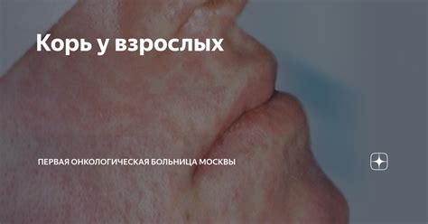 Корь у взрослых Онкологический центр №1 ГКБ им С С Юдина Дзен