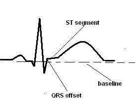 ST Segment Deviation Download Scientific Diagram