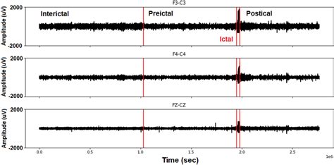 Epilepsy Phases In A Long Time EEG Recording For Convenience Only Download Scientific Diagram