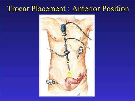 Laparoscopic Colon Resection Anterior Approach Ppt