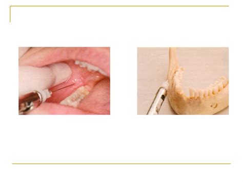 Mandibular Injection Technique Ppt