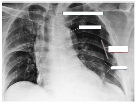 Cxr Tension Pneumothorax Quiz