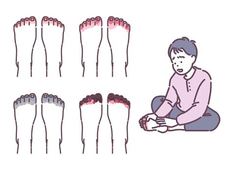 Premium Vector Illustration Of A Person With Frostbite On His Foot