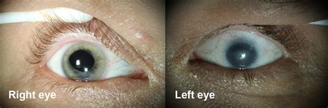 Microphthalmia Anophthalmia Coloboma Mac For Patients Gene Vision