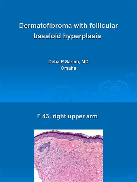Dermatofibroma With Follicular Basaloid Hyperplasia F 43 Right Arm