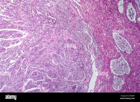 Photomicrograph Of Small Cell Lung Cancer Revealing Densely Packed