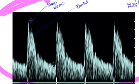 Vascular 2 Exam Review Renal Flashcards Quizlet