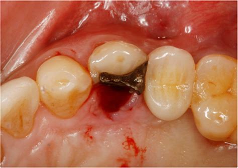 Clinical Scenario 2 Preoperative View Of A Fractured Maxillary