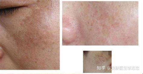 中医学对黄褐斑的认识 知乎