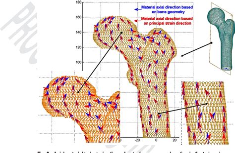 Figure 1 From Patient Specific Finite Element Analyses Of The Proximal Femur With Orthotropic