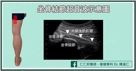 跌坐後屁股一坐就痛，小心「坐骨結節」受傷！復健科醫揭5大解方 Uho優活健康網