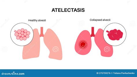 Atelectasis Medical Poster Vector Illustration
