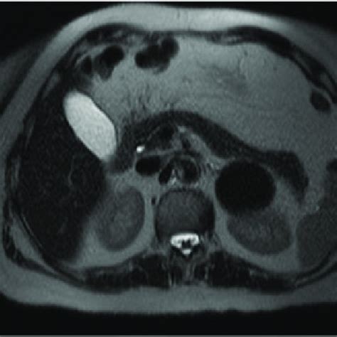Morphology Of Ectopic Thyroid Tissue In The Adrenal Gland In Patient 1 Download Scientific