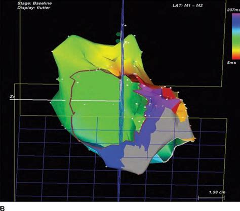 Isthmus Dependent Atrial Flutter Basicmedical Key