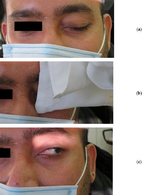 Figure 1 From Ice Pack Test Eased Ptosis In A Patient Presenting With A