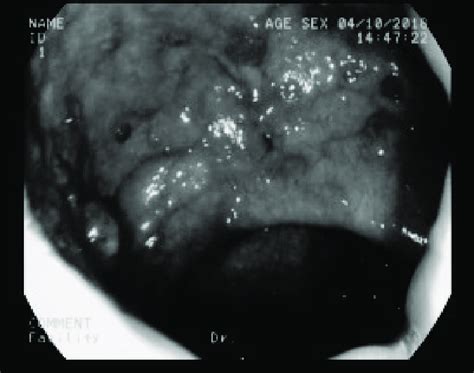 Polyps Of Different Sizes Were Seen In Rectosigmoid Junction Download Scientific Diagram