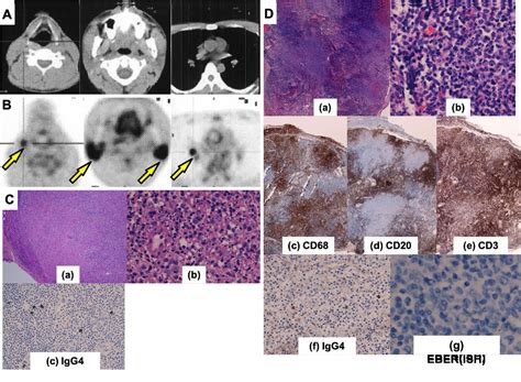 Figure 2 From A Case Of Repeated Necrotizing Lymphadenitis With Mefv