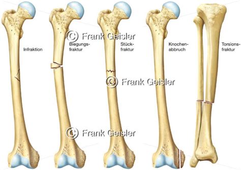 Knochenbrüche Frakturen Der Knochen Knochenfrakturen Medical Pictures