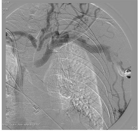 Short Segment Occlusion In Left Brachicephalic Vein Download
