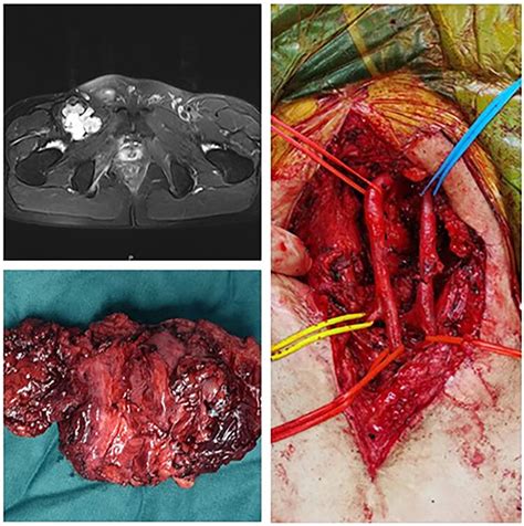 Schematic Illustration Of The Vascular Choroid Following Vascular Download Scientific Diagram