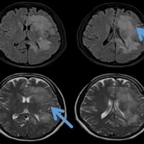 Multi‐contrast Magnetic Resonance Imaging Mri Showing Mild Diffusion