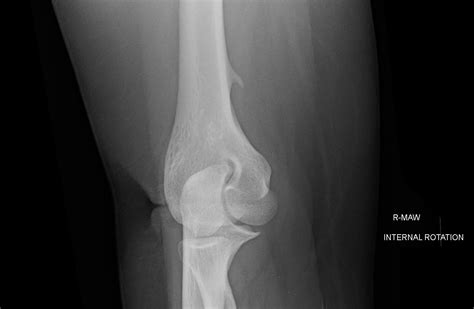 Orthodx Bony Growth Near Elbow Clinical Advisor