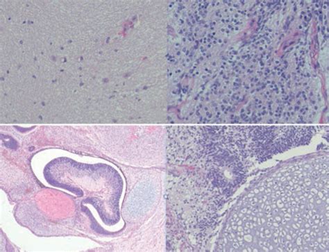 Pathologic Results Confirmed Diagnosis Of Immature Teratoma Download